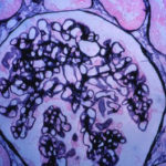 The Ponticelli Protocol - Renal Fellow Network