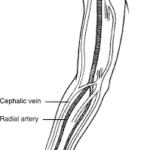 Physical Exam for AV Fistulas & Grafts - Renal Fellow Network