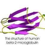 Beta-2 Microglobulin Amyloidosis - Renal Fellow Network