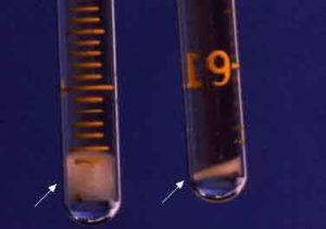 Urine eosinophils - Renal Fellow Network
