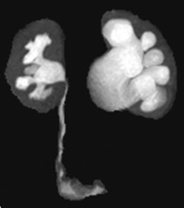 Horseshoe Kidney versus Crossed Fused Ectopia - Renal Fellow Network