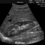 Differential Diagnosis for Large Kidneys - Renal Fellow Network
