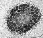 Vancomycin & Red Man Syndrome - Renal Fellow Network