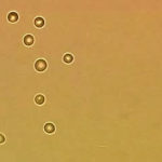 Microhematuria in Potential Kidney Donors - Renal Fellow Network