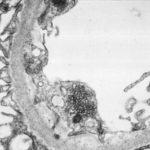 Reticular Inclusions in HIVAN - Renal Fellow Network