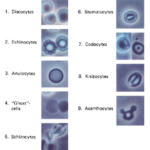 The Acanthocyte - Renal Fellow Network