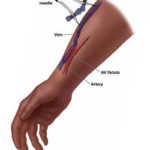 Preop Vascular Mapping for AVF/AVG - Renal Fellow Network