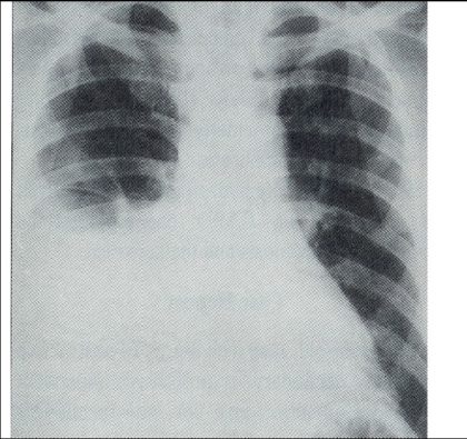Hypercalcemia of Malignancy - Renal Fellow Network
