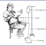 Basics of PD prescription writing - Renal Fellow Network