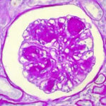 Idiopathic Nodular Glomerulosclerosis Archives - Renal Fellow Network
