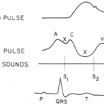 Jugular venous distension - clinical studies - Renal Fellow Network