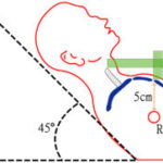 Jugular venous distention- the physical exam - Renal Fellow Network