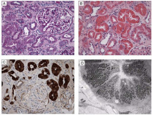 Bactrim prophylaxis with high-dose steroid use? - Renal Fellow Network