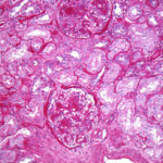 Idiopathic Nodular Glomerulosclerosis Archives - Renal Fellow Network