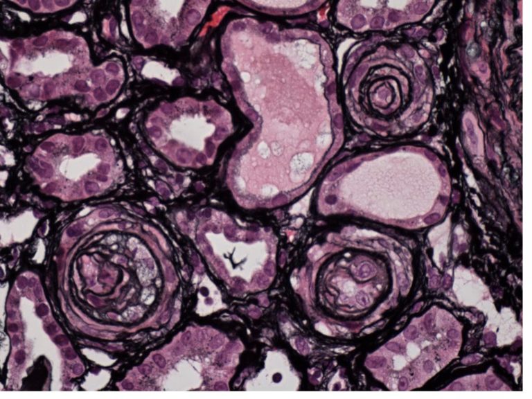 Hypokalemic Periodic Paralysis - Renal Fellow Network
