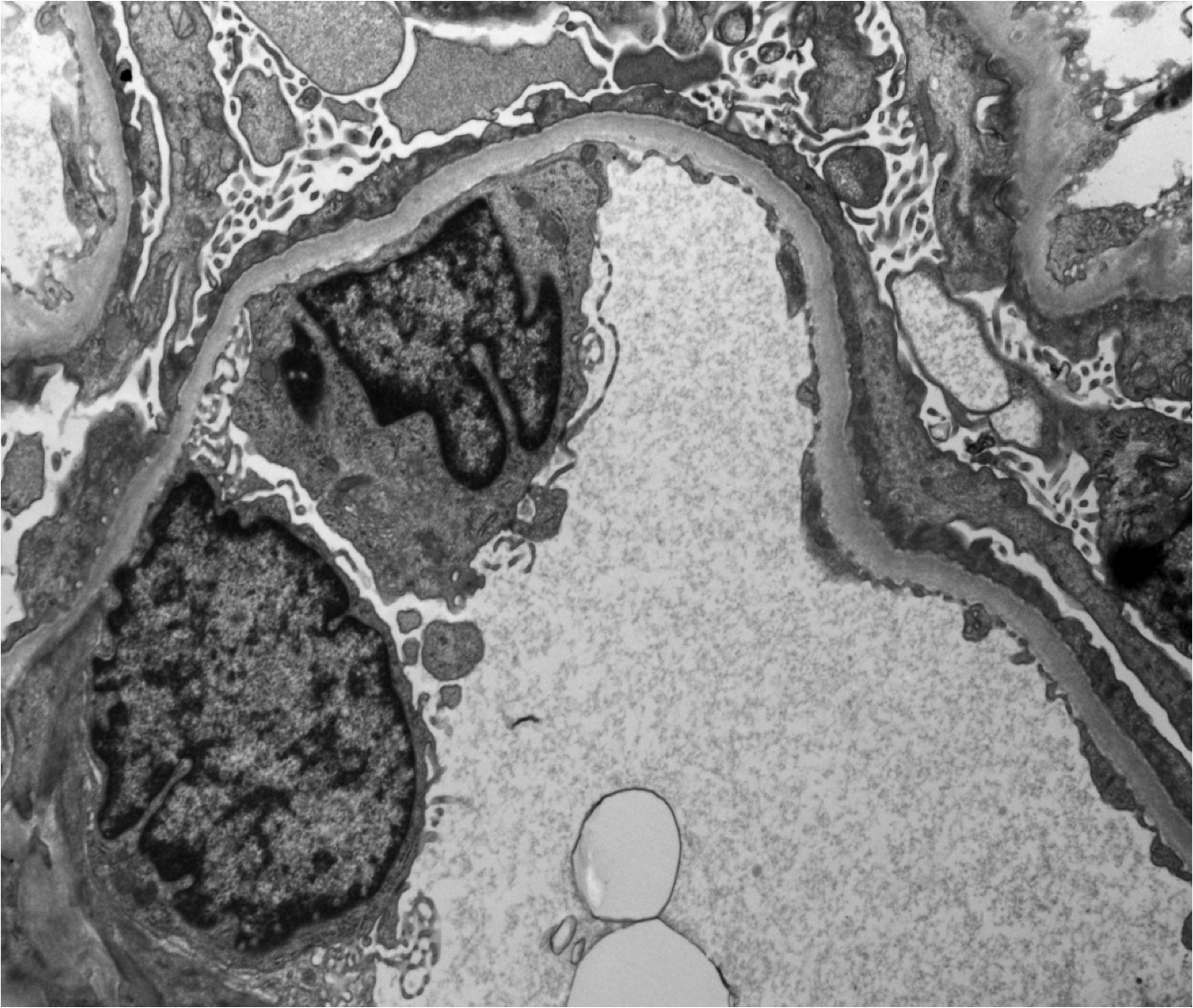 FSGS biomarker updates—suPAR, B7-1, CD40 and more… - Renal Fellow Network