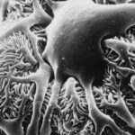 Lupus Podocytopathy - Renal Fellow Network