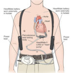 LVAD for the Nephrologist-Part 1 - Renal Fellow Network