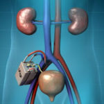 An Artificial Implantable Kidney: Basics for Nephrologists and Fellows ...