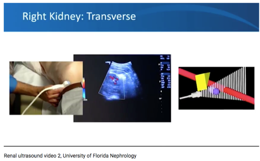 Point-of-Care Ultrasound (POCUS) Videos - Renal Fellow Network