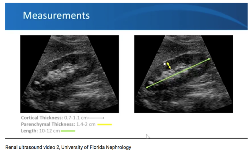 Point-of-Care Ultrasound (POCUS) Videos - Renal Fellow Network