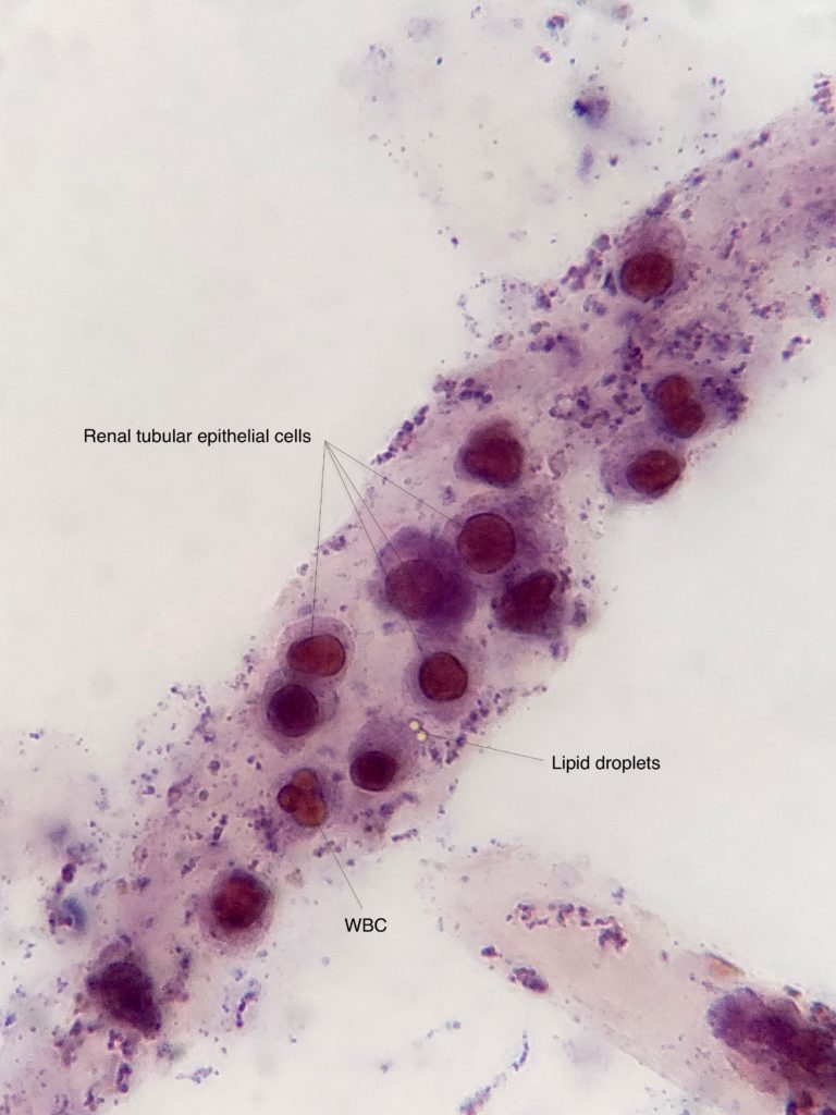 Urine Sediment of the Month: Renal Tubular Epithelial Cells - Renal ...