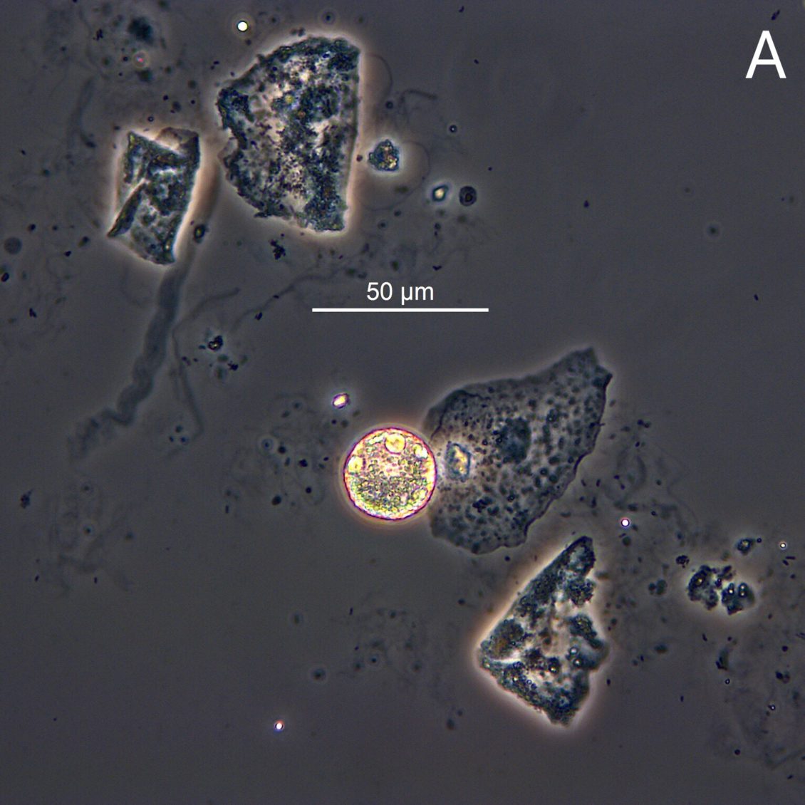 Urine Sediment of the Month: Fat Oval Bodies - Renal Fellow Network