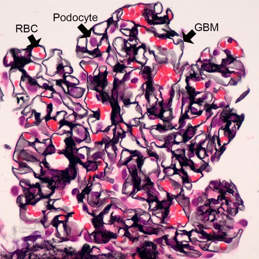 Kidney Biopsy of the Month: What is Normal? - Renal Fellow Network