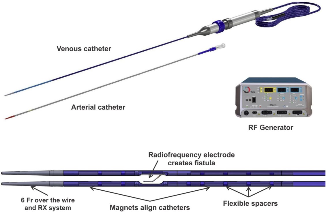 Endovascular Technique for Arteriovenous Fistula Creation - Renal ...