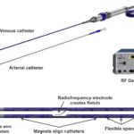 Endovascular Technique for Arteriovenous Fistula Creation - Renal ...