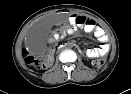 Urine Sediment of the Month: Waxy Casts - Renal Fellow Network