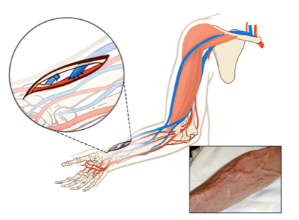 Dialysis Fistula Diagram