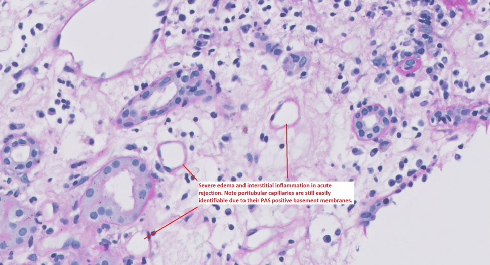 Kidney Biopsy of the Month- The Tubulointerstitium Part 1: The Cortex ...