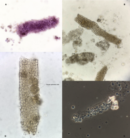 Urine Sediment of the Month: RBC Casts, Ghost Cells, & Heinz Bodies ...