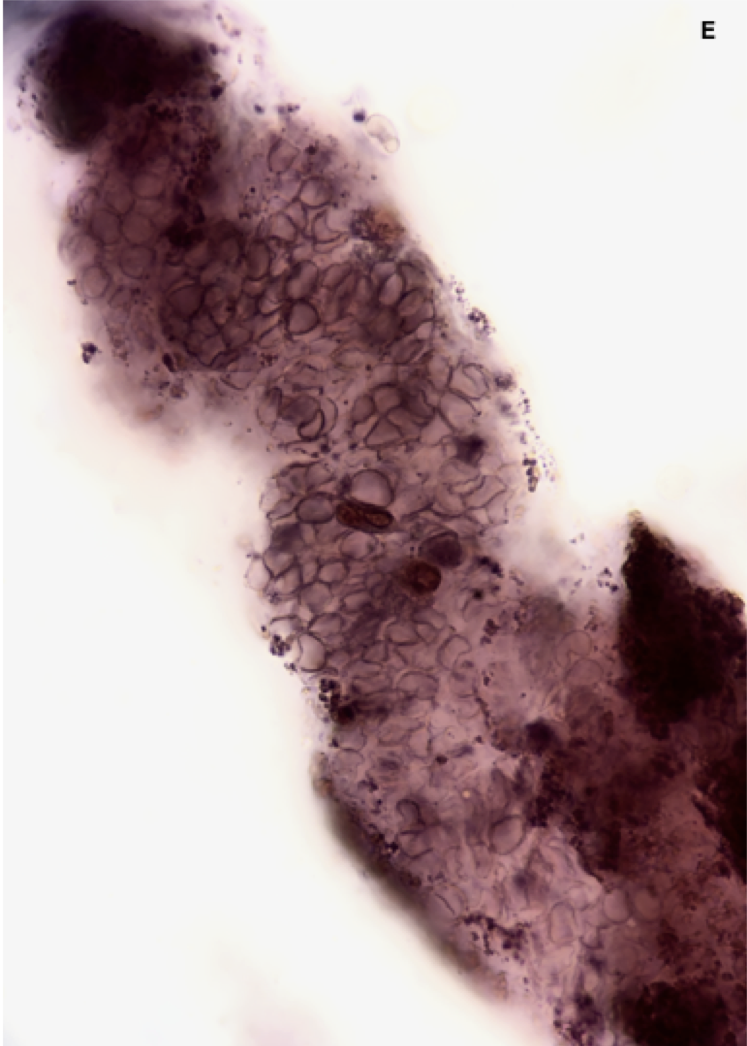 Urine Sediment of the Month: RBC Casts, Ghost Cells, & Heinz Bodies ...