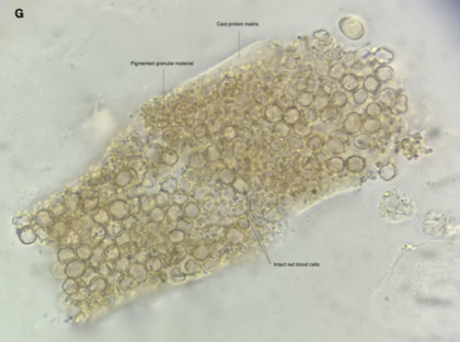 Urine Sediment of the Month: RBC Casts, Ghost Cells, & Heinz Bodies ...