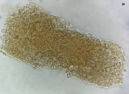 Urine Sediment of the Month: RBC Casts, Ghost Cells, & Heinz Bodies ...