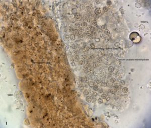Urine Sediment of the Month: RBC Casts, Ghost Cells, & Heinz Bodies ...