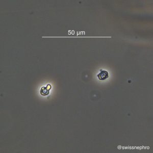 Urine Sediment of the Month: Dysmorphic RBCs, the Hallmark of ...