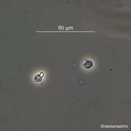 Urine Sediment of the Month: Dysmorphic RBCs, the Hallmark of ...