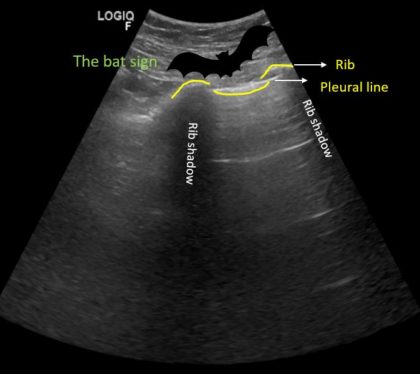 Basics of Lung Ultrasound for the Nephrologist: What are A-lines and B ...