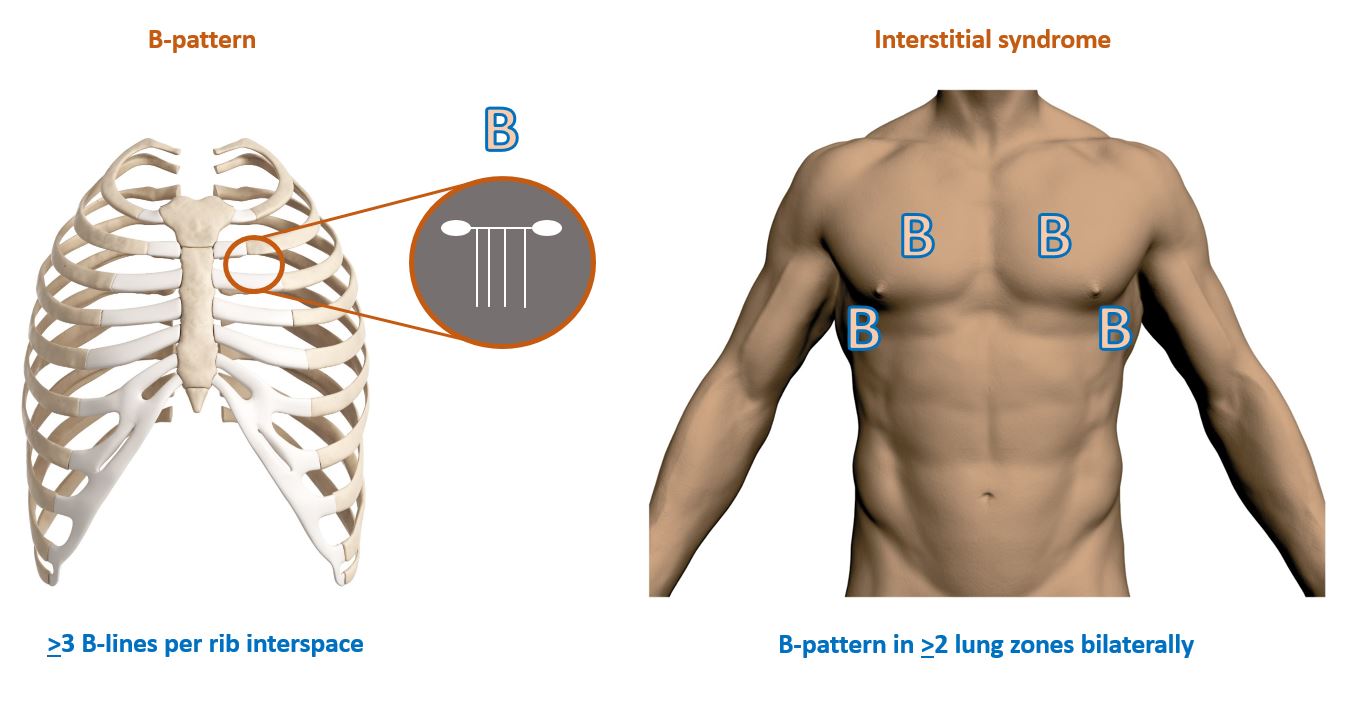 Basics of Lung Ultrasound for the Nephrologist: What are A-lines and B ...
