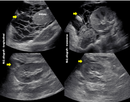 POCUS Gallery - Renal Fellow Network