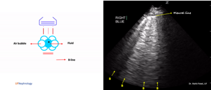 Basics of Lung Ultrasound for the Nephrologist: What are A-lines and B ...