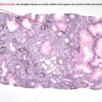 Kidney Biopsy of the Month- The Tubulointerstitium Part 2: The Medulla ...