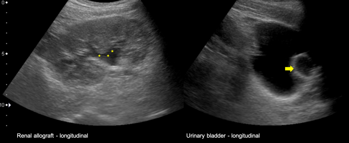 POCUS Gallery - Renal Fellow Network