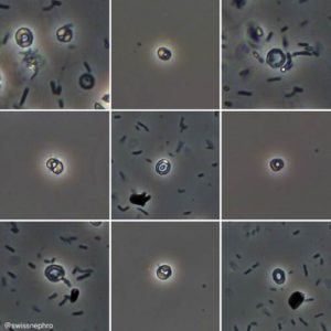 Urine Sediment of the Month: Dysmorphic RBCs, the Hallmark of ...