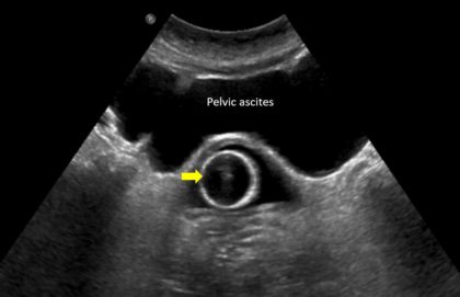 POCUS Gallery - Renal Fellow Network
