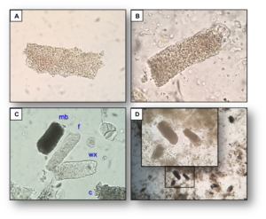 Urine Sediment of the Month: Granular & "Muddy Brown" Casts - Renal ...