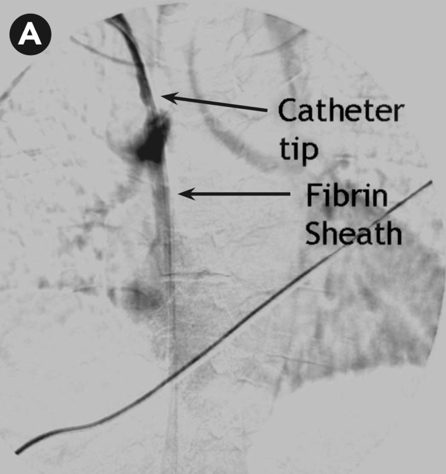 Interventional Nephrology Series - Renal Fellow Network